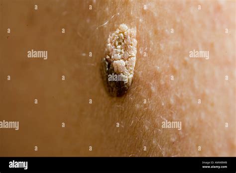 Common Wart Verruca Senilis Stock Photo 8766938 Alamy