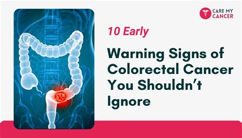 10 Early Warning Signs of Colorectal Cancer You Shouldn’t Ignore ...