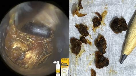 Ear Wax Chunk