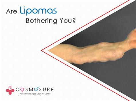 Lipomas Are Small Accumulated Fats That Form A Mass Mainly In The