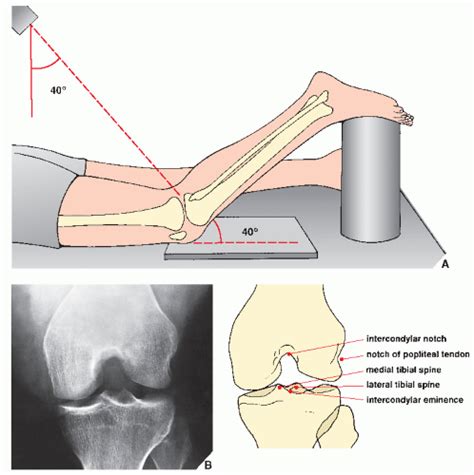 Intercondylar Notch