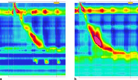 High Resolution Manometry Findings Before A And 1 Year After B Linx Download Scientific