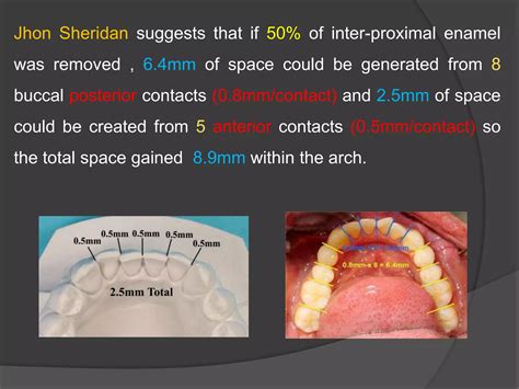 Interproximal Enamel Reduction Stripping Ppt