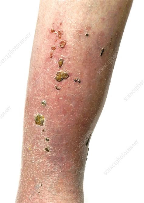 Itchy Scab