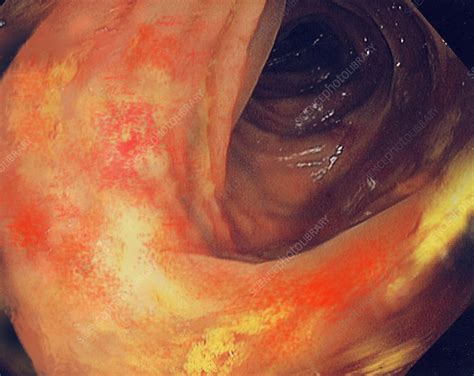 Colon Ulcer Stock Image C0219848 Science Photo Library