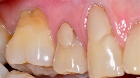 Exposed Tooth Root Treatment In Spring Orchid Dental Clinic