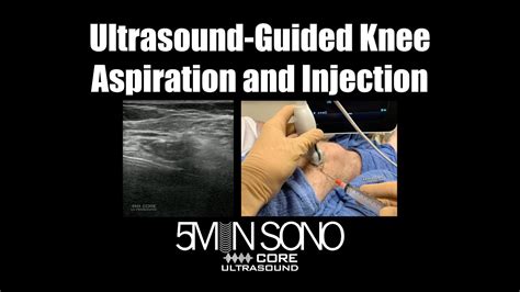 Ultrasound Guided Knee Aspiration And Injection A Step By Step Guide Youtube