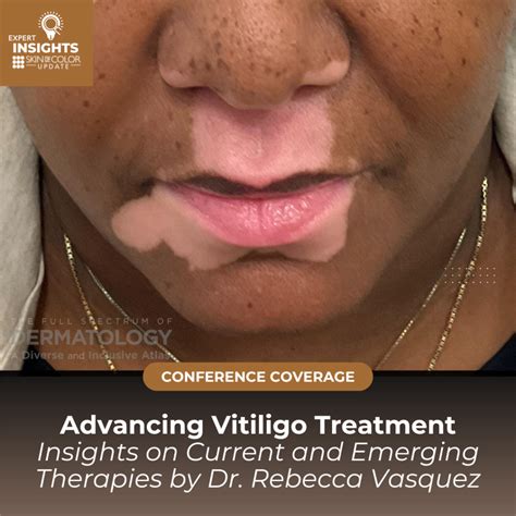 Advancing Vitiligo Treatment Insights On Current And Emerging