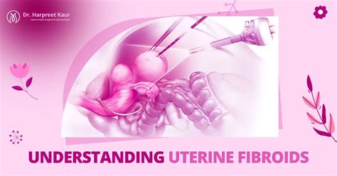 Understanding Uterine Fibroids