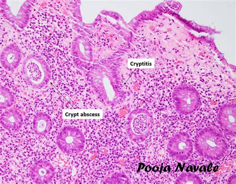 Jerad Gardner Md On Twitter Rt Navalepooja This Immune Checkpoint