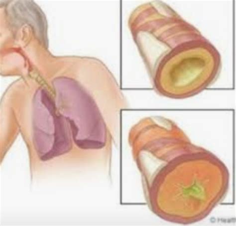 Broncoespasmo Tv Broncoespasmo Tv