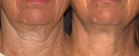 Sofwave™ Phdermatology