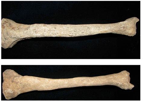 Ray Examination Is Available Fig 19 Lesions In The Tibia