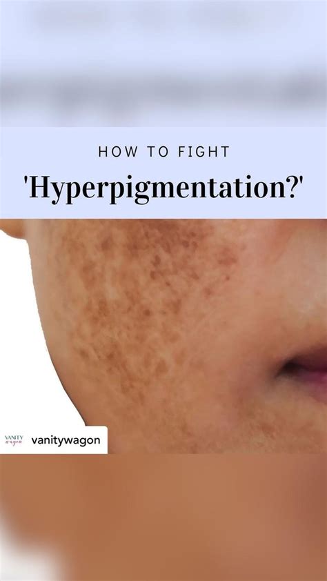 Hyperpigmentation Lose 40 Pounds Saggy Skin Natural Sleep Remedies