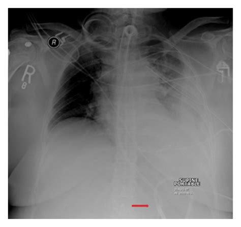 A Cxr Showing An Ngt Forming A Loop Within The Fundus Of The Stomach