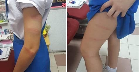Investigation Launched After Teachers Caning Leaves Red Marks On Girl