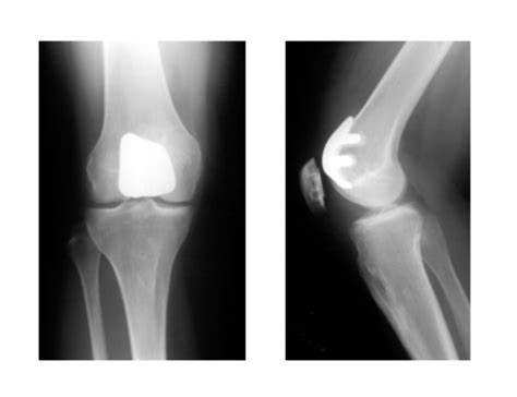Unicompartmental Segmental Bicompartmental Total Knee 45 Off