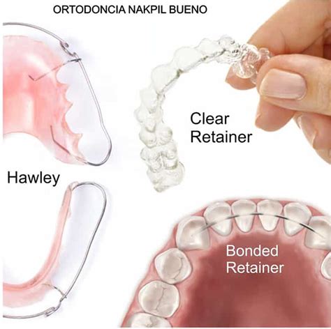 Removable Retainers Dr Keiths Dental Clinic
