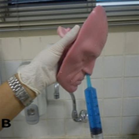 Examples Of High Amount Of Fluid In The Sinuses A Left Maxillary