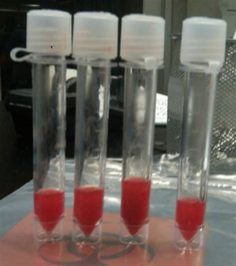 Bloody Csf — Pediatric Em Morsels