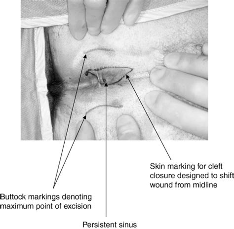 Perineal Proctectomy