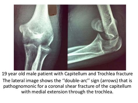 Capitellum Fractures