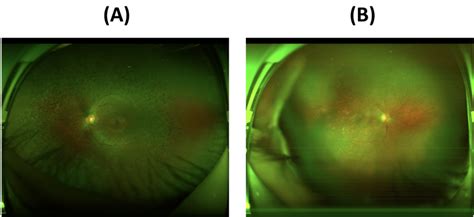 [논문 리뷰] Deep Learning Based Detection Of Referable Diabetic Retinopathy And Macular Edema Using