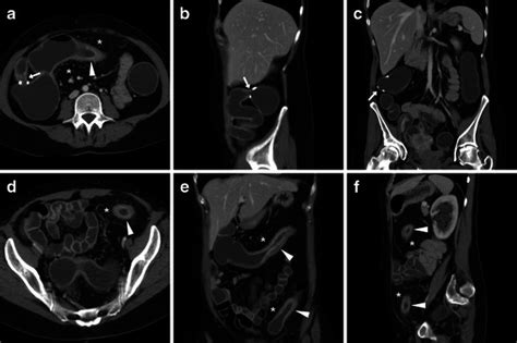 A 52 Year Old Female With Previous Ileocecal Resection For Crohns