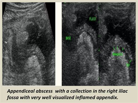 Presentation1pptx Ultrasound Examination Of The Appendix Pptx