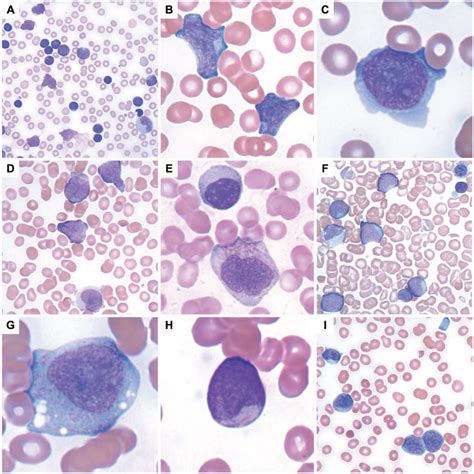 Figure 1 From Malignant Or Benign Leukocytosis Semantic Scholar