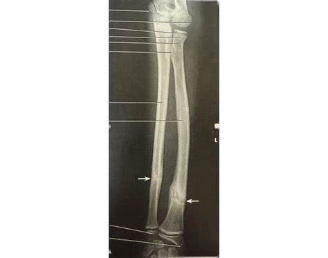 Ap Forearm X Ray Quiz
