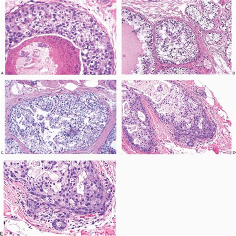 Ductal Carcinoma In Situ Basicmedical Key