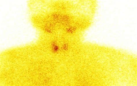Hybrid Spect Image Of Mibi Scan Used In Localizing The Abnormal
