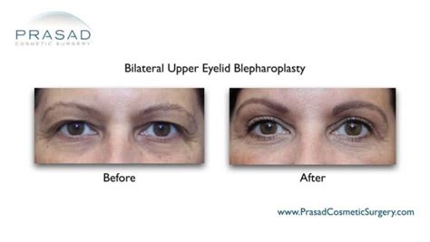 What Causes Heavy Lidded Eyes And How To Treat Them