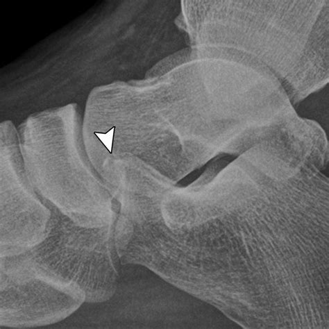 Acute Fracture Of The Anterior Process Of Calcaneus Does It Herald A