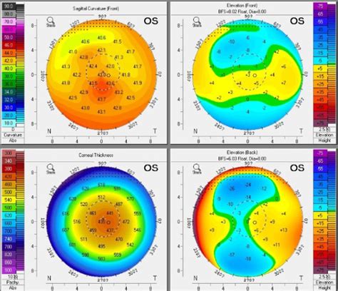 Corneal Topography Showed A Central Inferior Steepened Zone