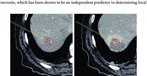 Ablation Zone Validation With The Tumor On The Pre Ablation Scan Left Download High