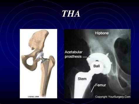 Ppt Hip Arthroplasty Powerpoint Presentation Free Download Id6713349