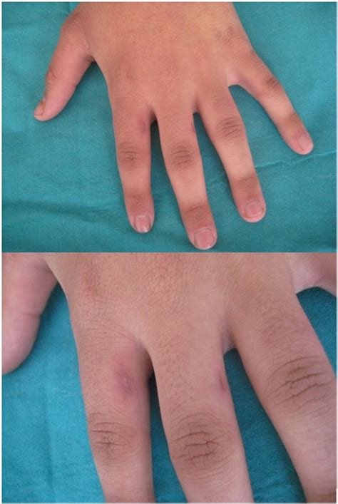 Ablative Co2 Laser For The Treatment Of Pachydermodactyly Actas Dermo Sifiliográficas