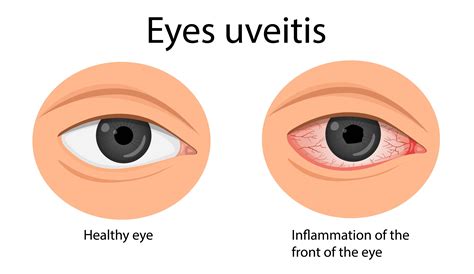 Uveitis Mid Atlantic Retina