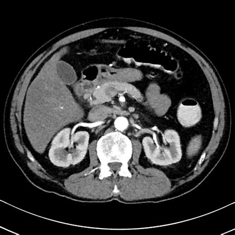 Filechronic Appendicitis Complicated By Appendicular Abscess