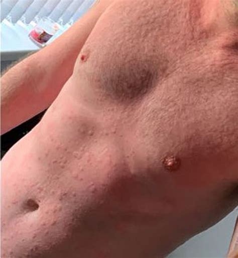 Stress Rash On Chest