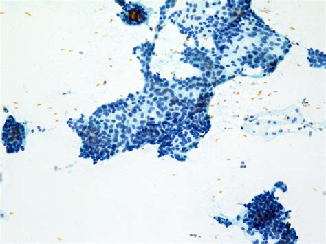 Pathology Outlines Neoplasm Salivary Gland Neoplasm Of Uncertain