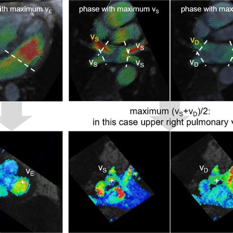 Evaluation Of Early Diastolic La Peak Outflow Velocity V E At The