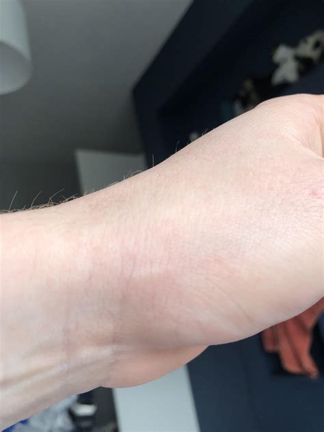 Is This A Burrow Rscabies