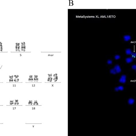 A Routine Cytogenetic Analysis Routine Cytogenetic Analysis Revealed