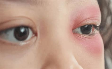 What To Do About Drooping Eyelids Causes And Effective Treatments