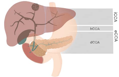 Strategy For Ercp Stenting In Cholangiocarcinoma