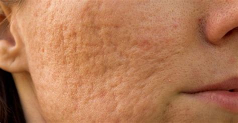 What Causes Skin Indentations On Face Rare Causes Explained