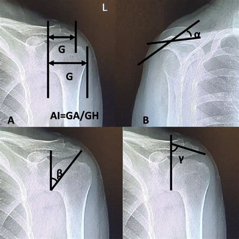 Radiographic Parameters Of Shoulder Joint Parameters A Acromion Index